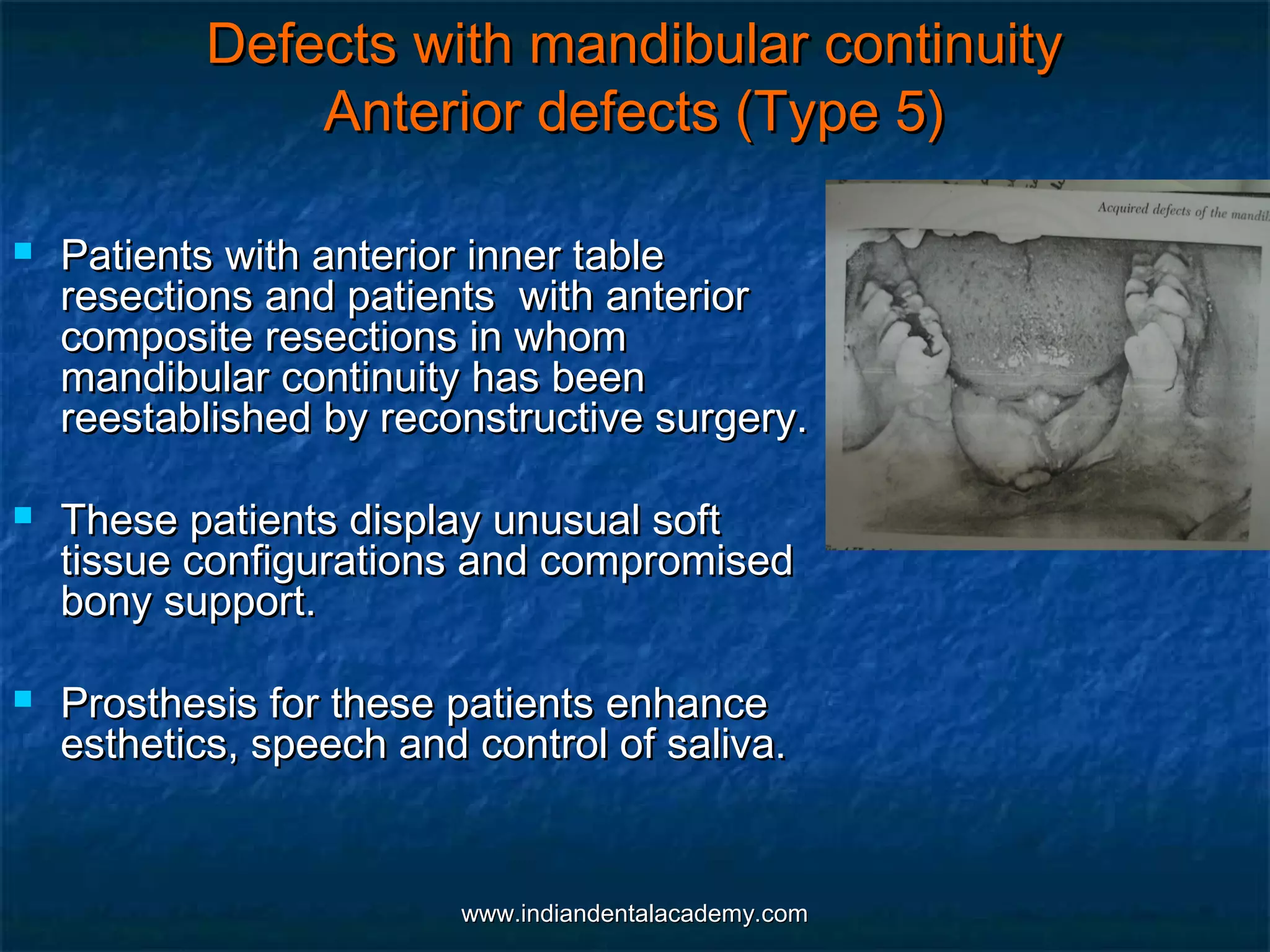 Prosthetic management of mandibulectomy and glossectomy pati ...