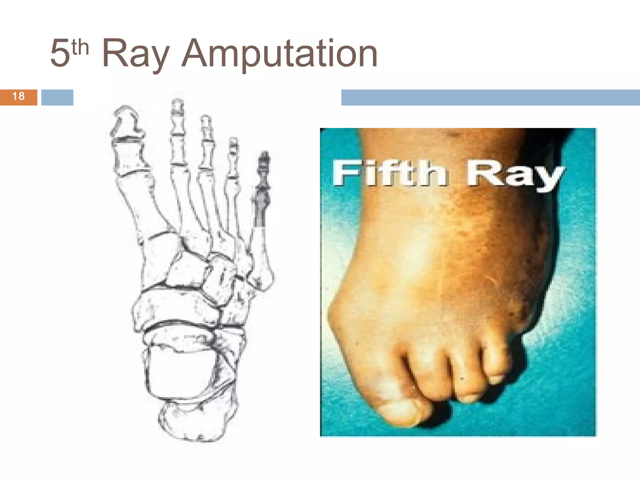Prosthetic management of symes and partial foot amputation | PPT