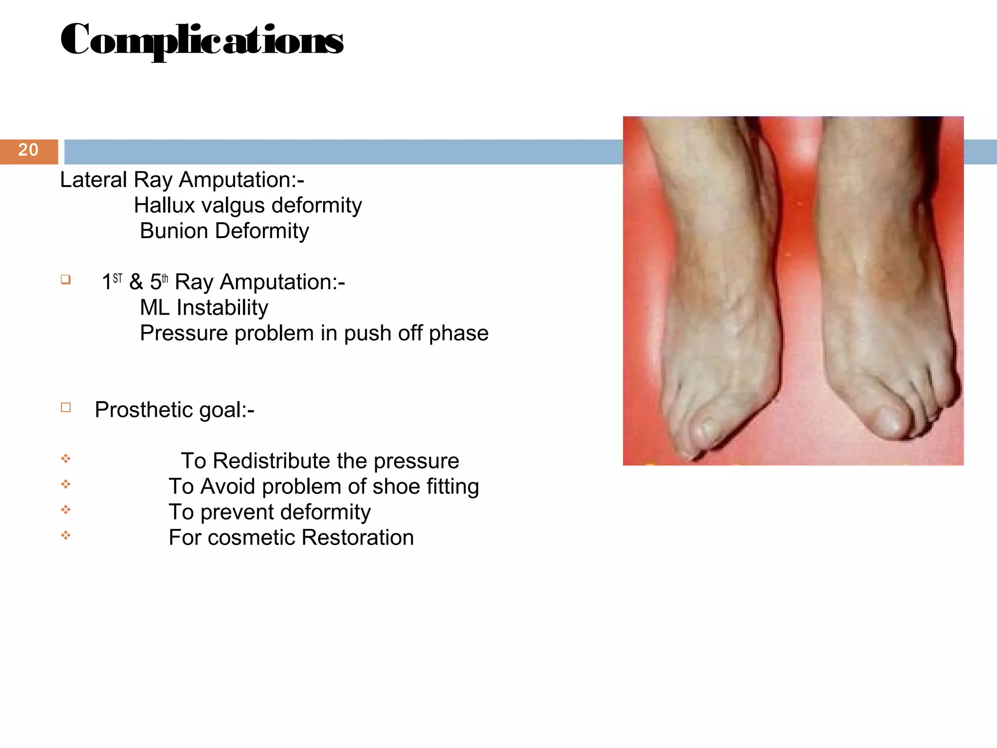 Prosthetic management of symes and partial foot amputation | PPT