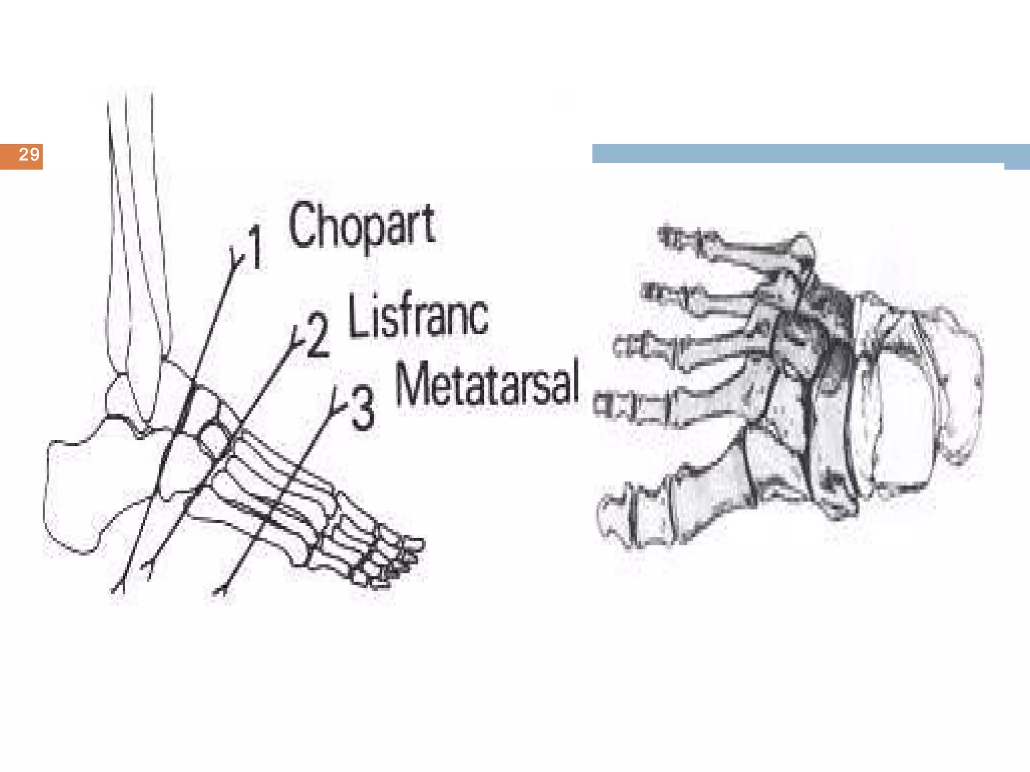 Prosthetic management of symes and partial foot amputation | PPT