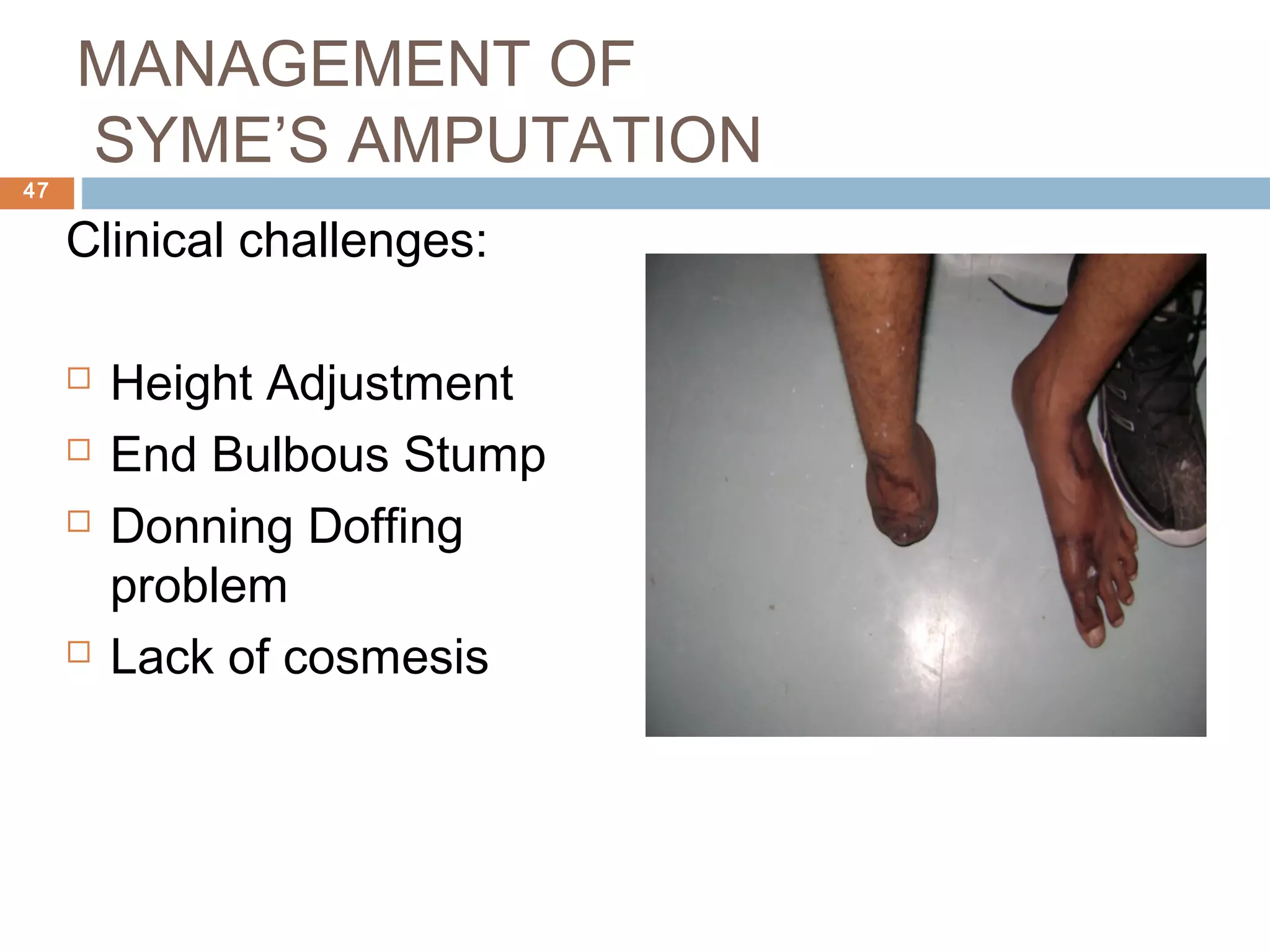 Prosthetic management of symes and partial foot amputation | PPT