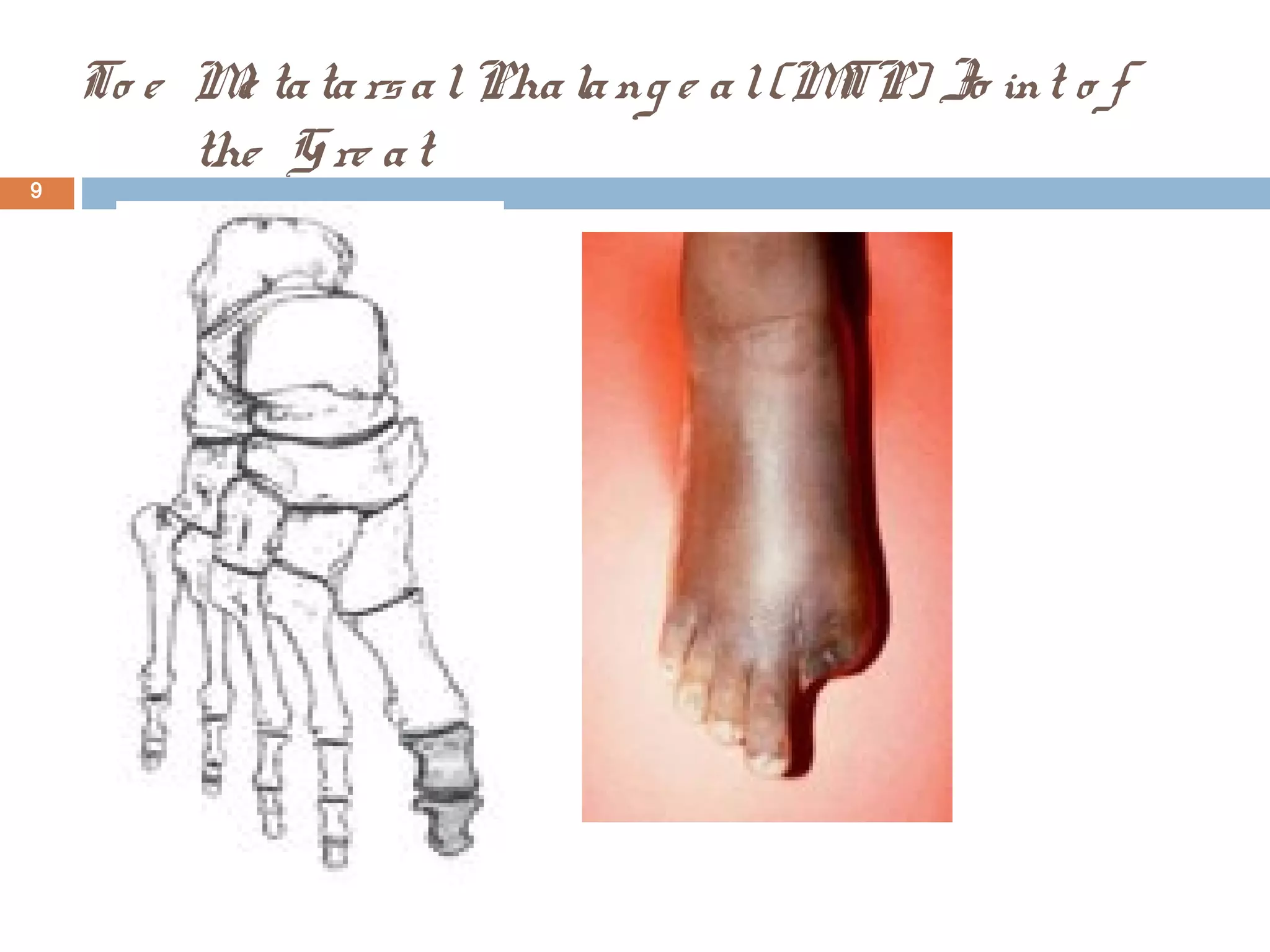 Prosthetic management of symes and partial foot amputation | PPT