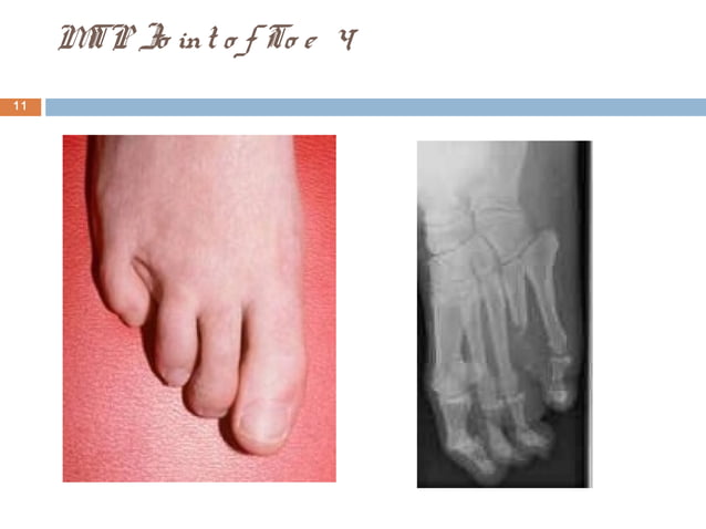 Prosthetic management of symes and partial foot amputation | PPT
