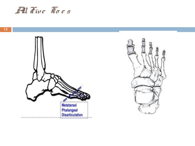 Prosthetic management of symes and partial foot amputation | PPT