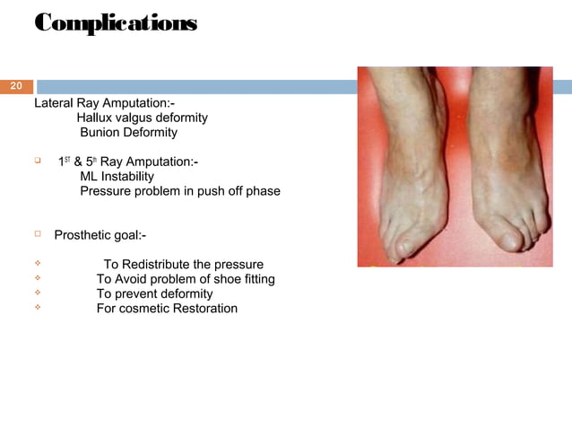 Prosthetic management of symes and partial foot amputation | PPT