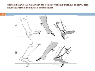 Prosthetic management of symes and partial foot amputation | PPT