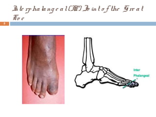 Prosthetic management of symes and partial foot amputation | PPT