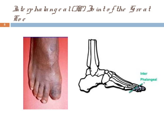 Prosthetic management of symes and partial foot amputation | PPT