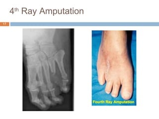 Prosthetic management of symes and partial foot amputation | PPT