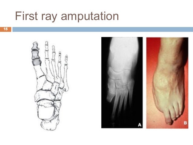 Prosthetic management of symes and partial foot amputation