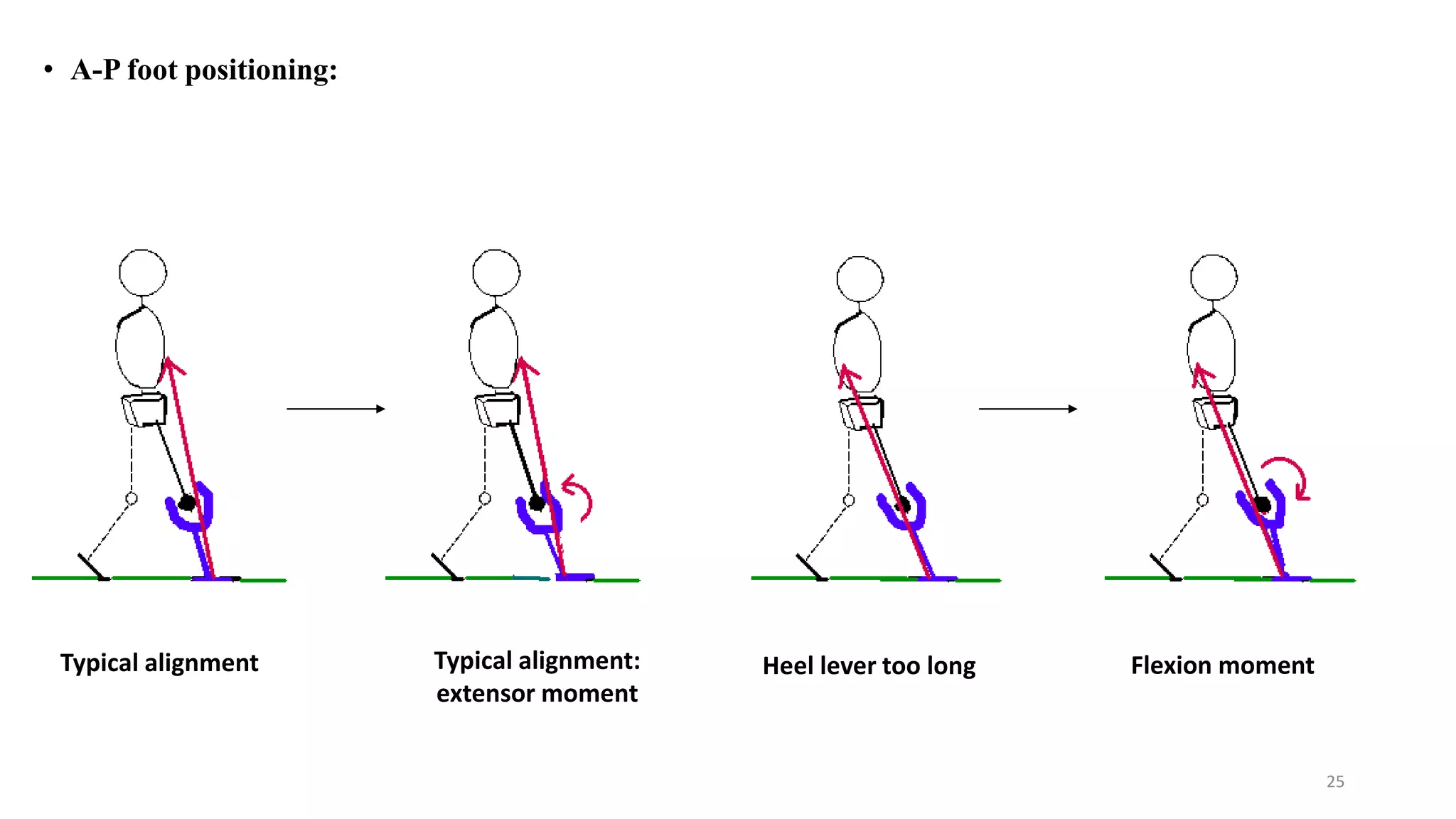 PROSTHETIC MANAGEMENT OF TRANSTIBIAL AMPUTATION AND ITS BIOMECHANICS | PDF