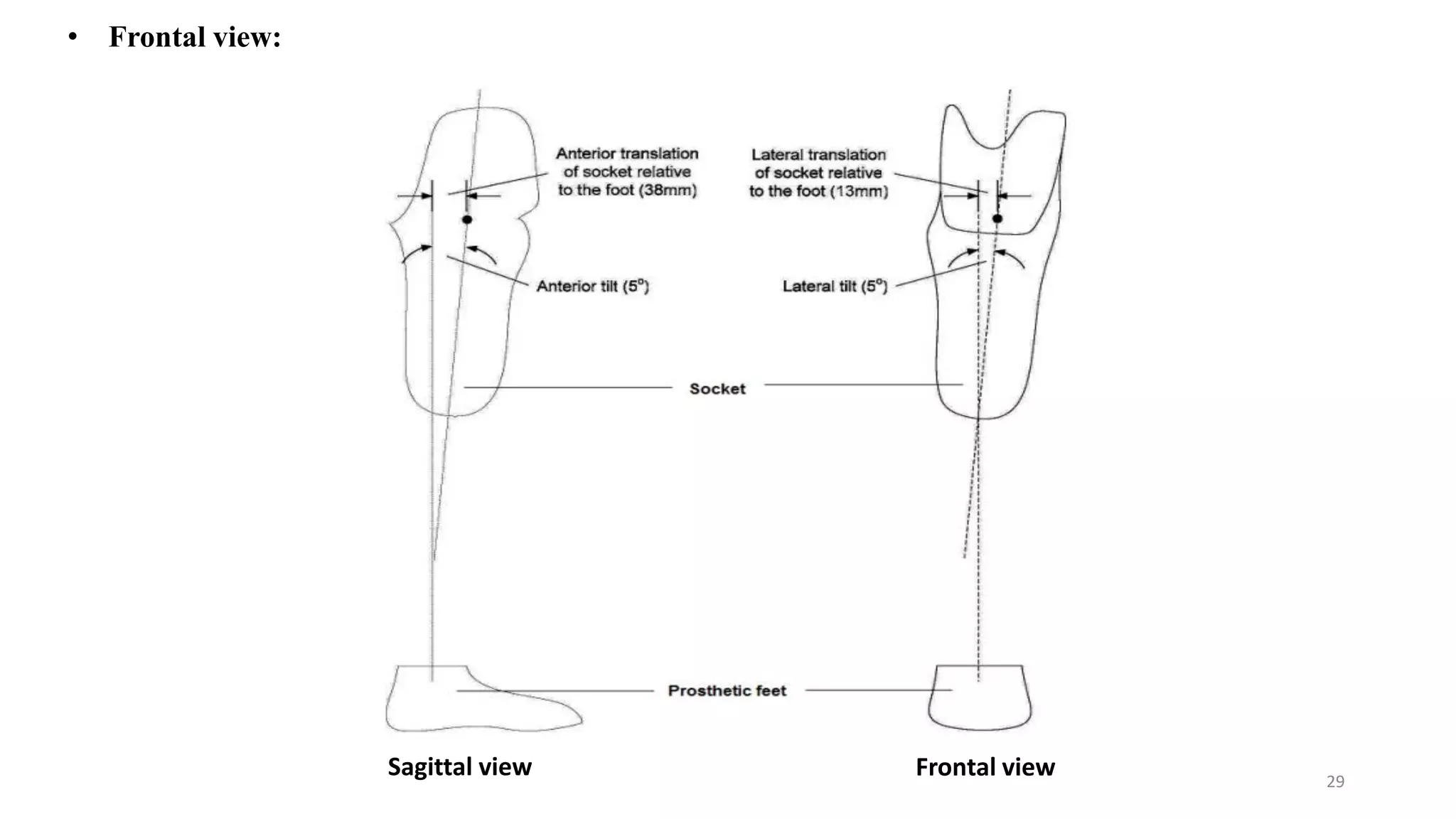 PROSTHETIC MANAGEMENT OF TRANSTIBIAL AMPUTATION AND ITS BIOMECHANICS | PDF