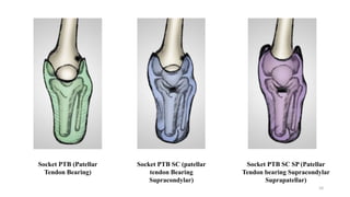 PROSTHETIC MANAGEMENT OF TRANSTIBIAL AMPUTATION AND ITS BIOMECHANICS | PDF