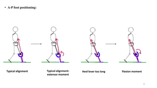 PROSTHETIC MANAGEMENT OF TRANSTIBIAL AMPUTATION AND ITS BIOMECHANICS | PDF