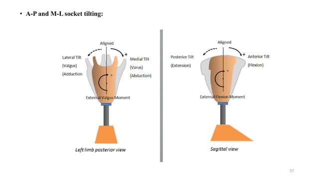 PROSTHETIC MANAGEMENT OF TRANSTIBIAL AMPUTATION AND ITS BIOMECHANICS | PDF