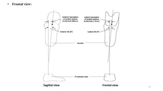 PROSTHETIC MANAGEMENT OF TRANSTIBIAL AMPUTATION AND ITS BIOMECHANICS | PDF