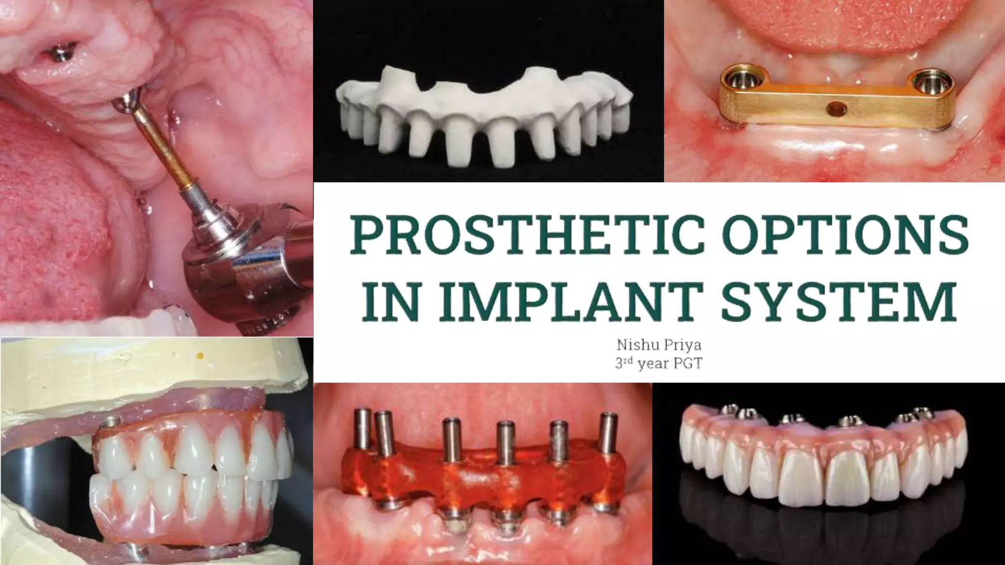 prosthetic options in implant | PPTX