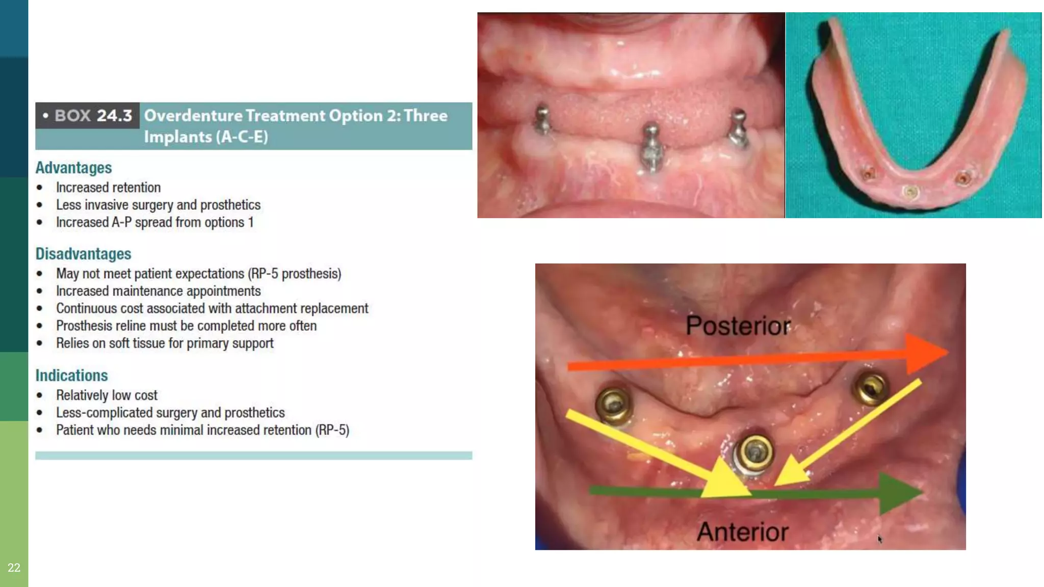 prosthetic options in implant | PPTX