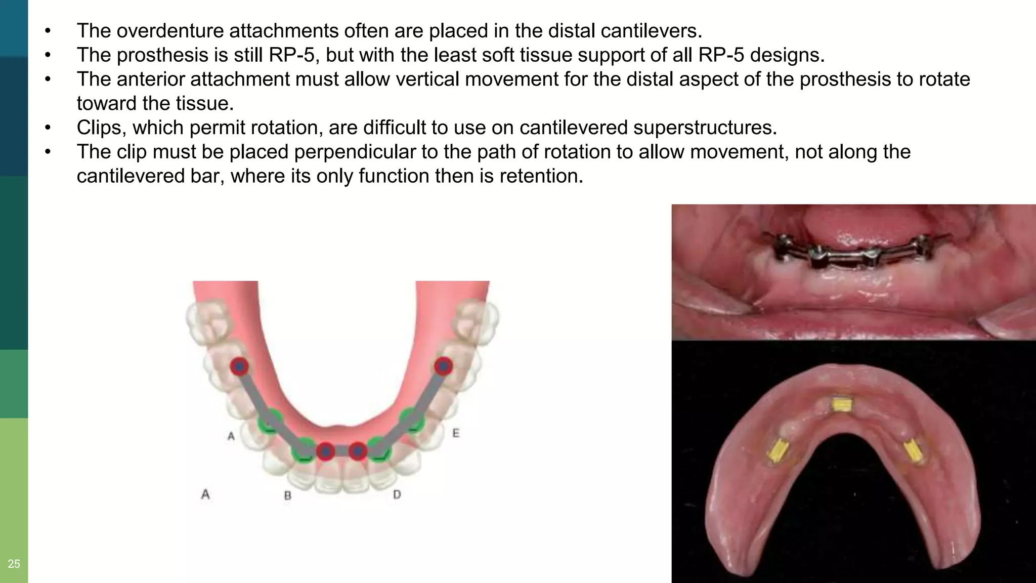 prosthetic options in implant | PPTX