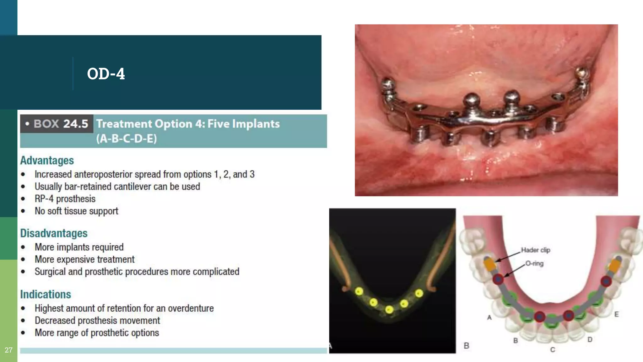 prosthetic options in implant | PPTX