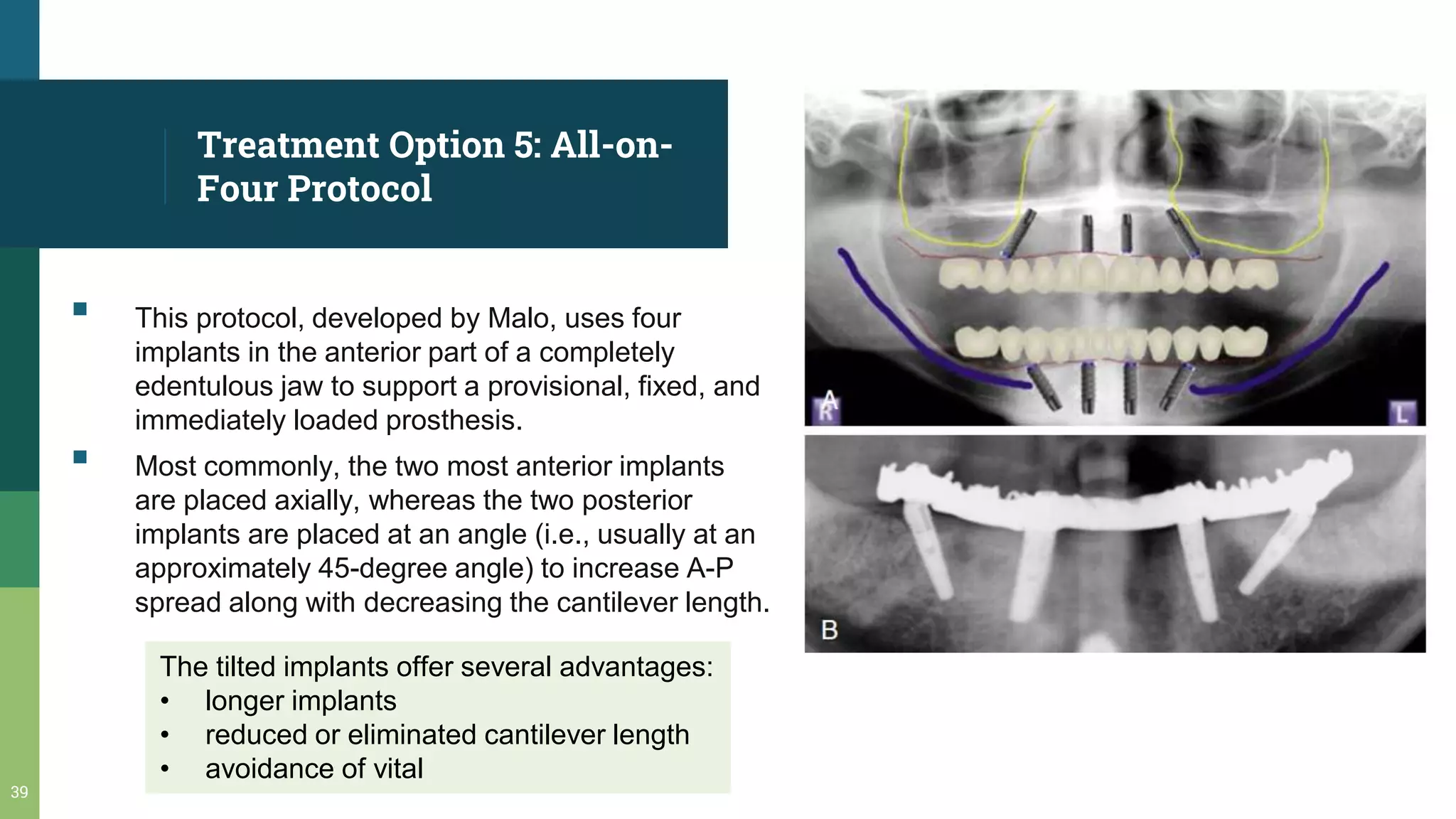 prosthetic options in implant | PPTX