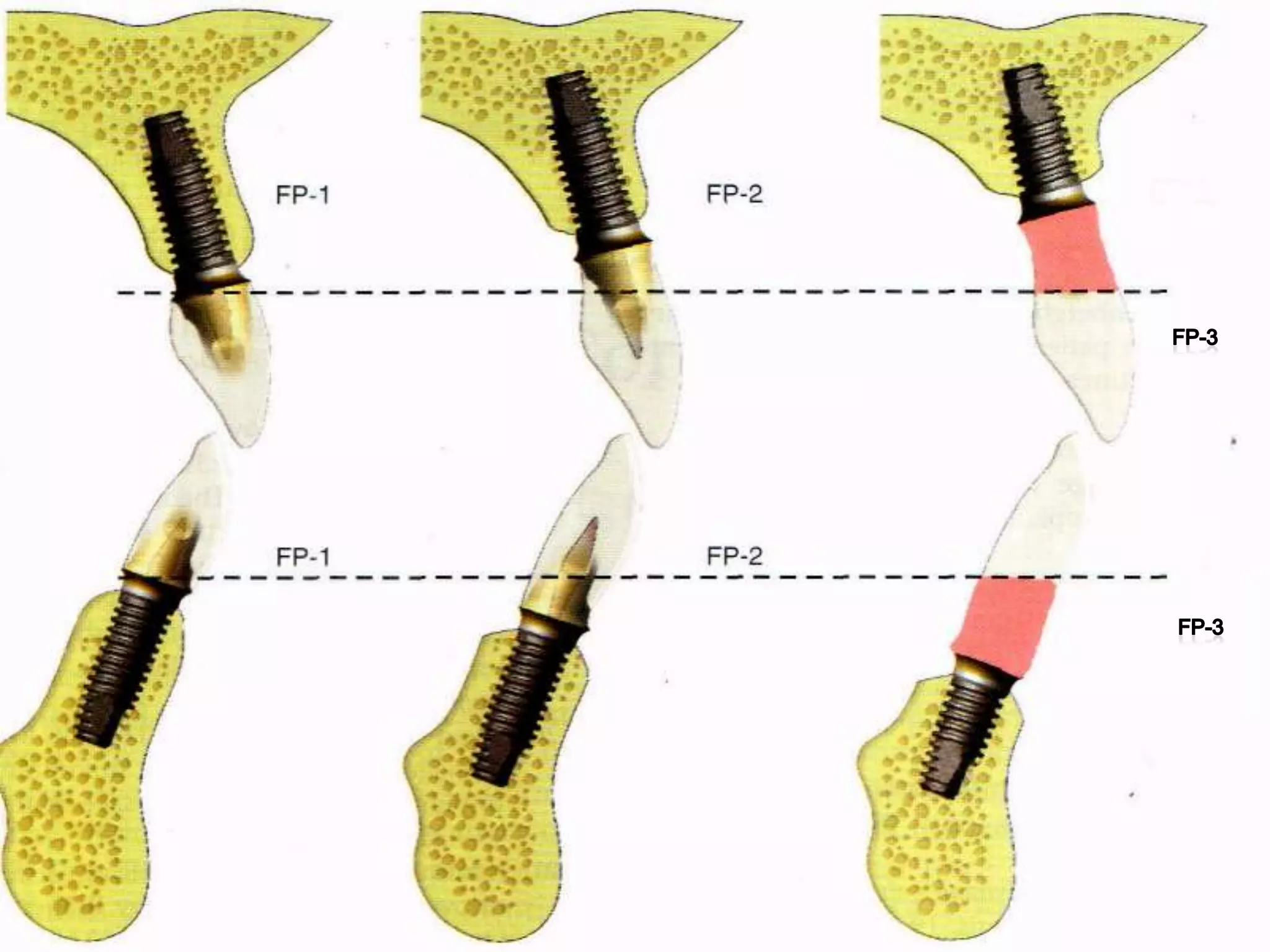 Prosthetic options in implant dentistry | PPTX