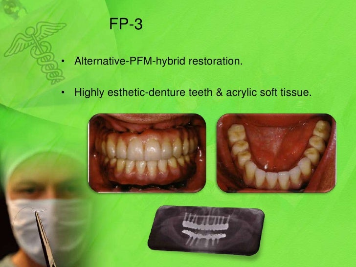 Prosthetic options in implant dentistry