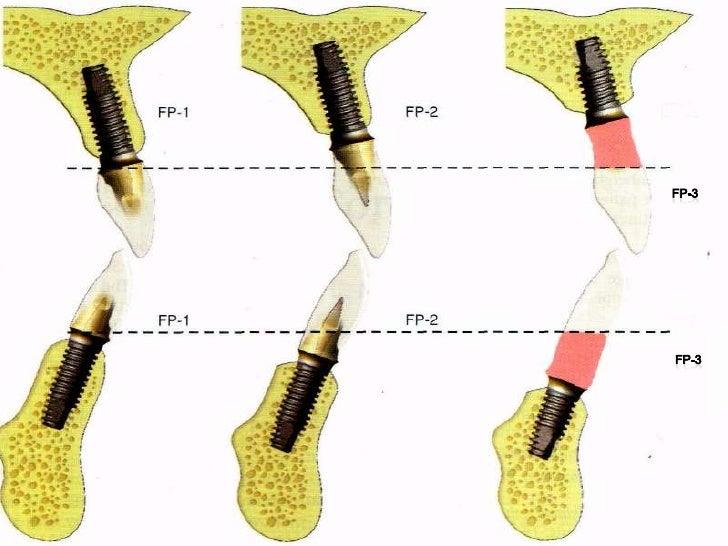 Prosthetic options in implant dentistry