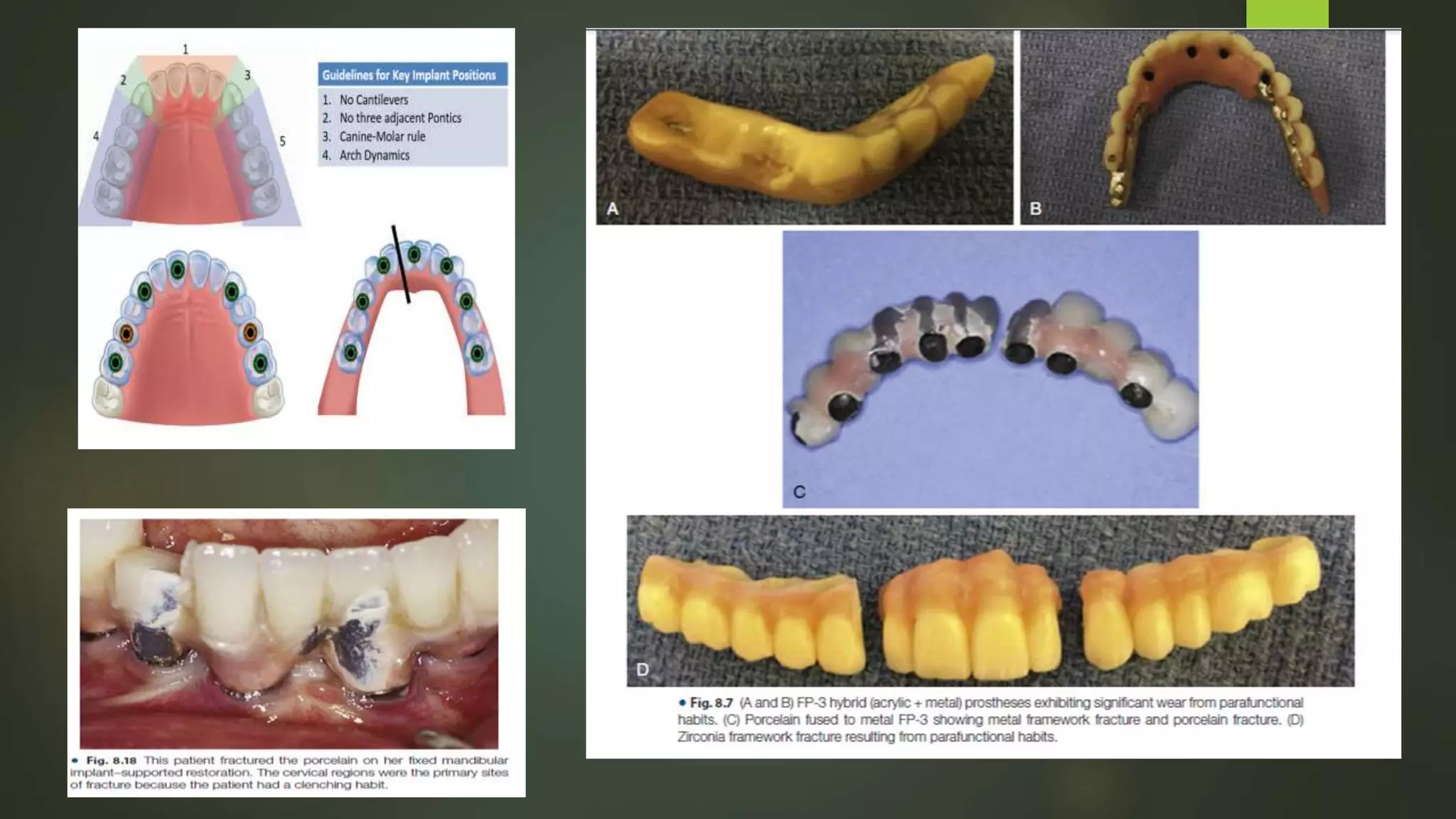 Prosthetic options in implant dentistry | PPTX