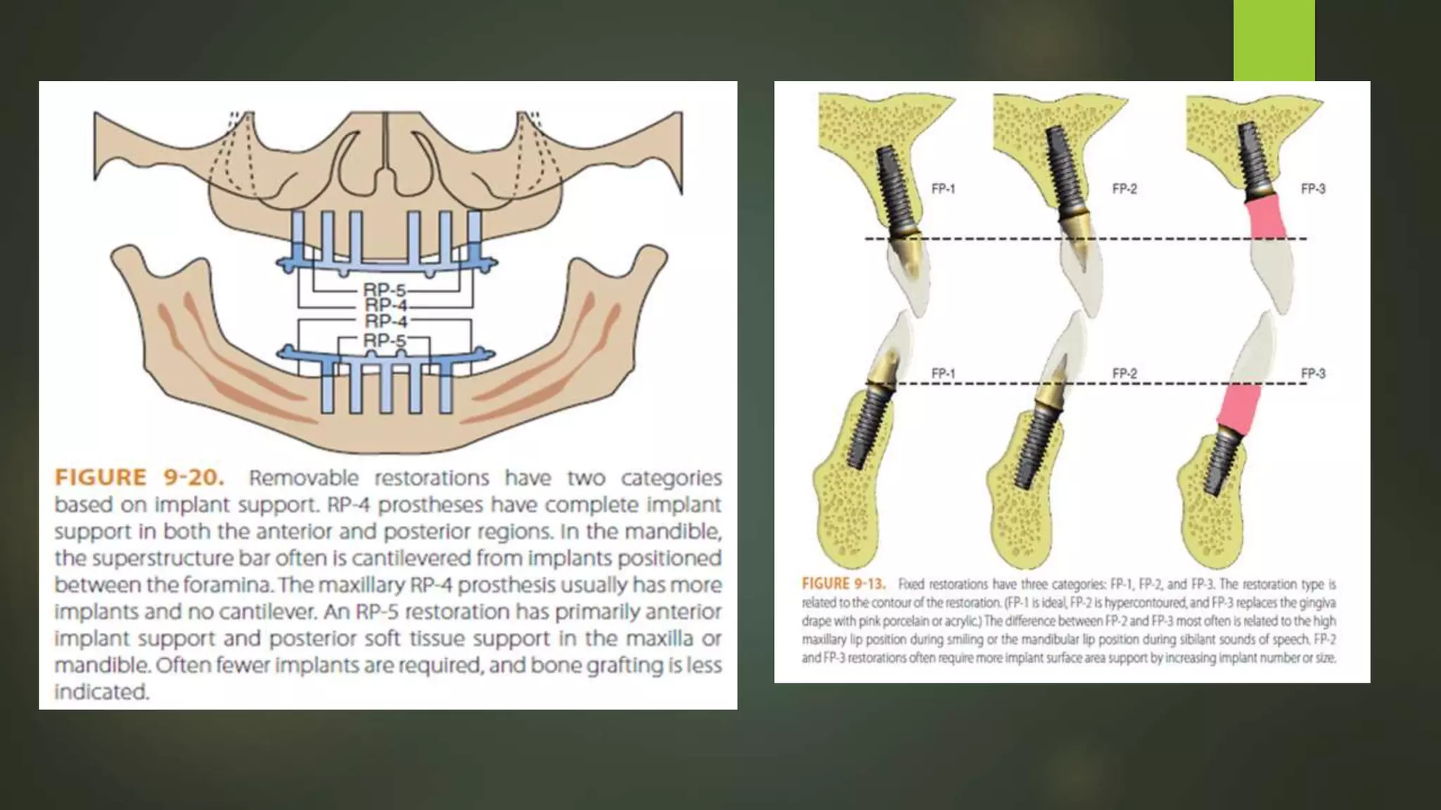 Prosthetic options in implant dentistry | PPTX