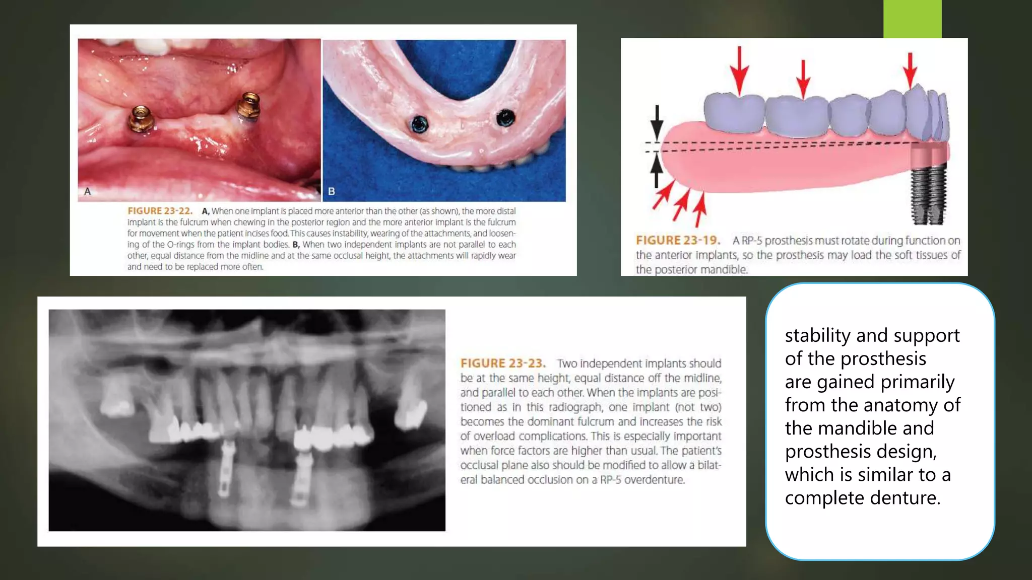 Prosthetic options in implant dentistry | PPTX