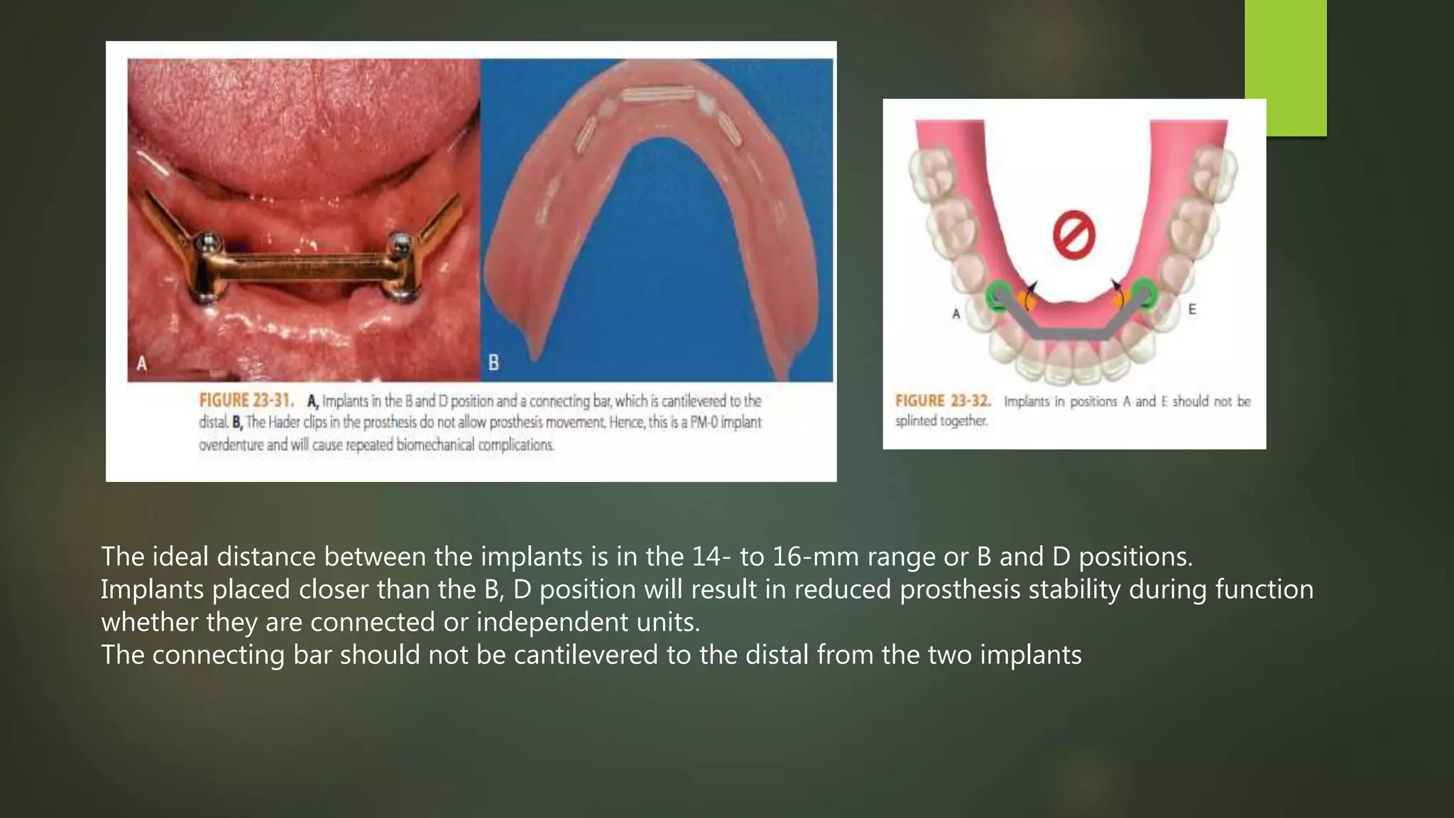 Prosthetic options in implant dentistry | PPTX