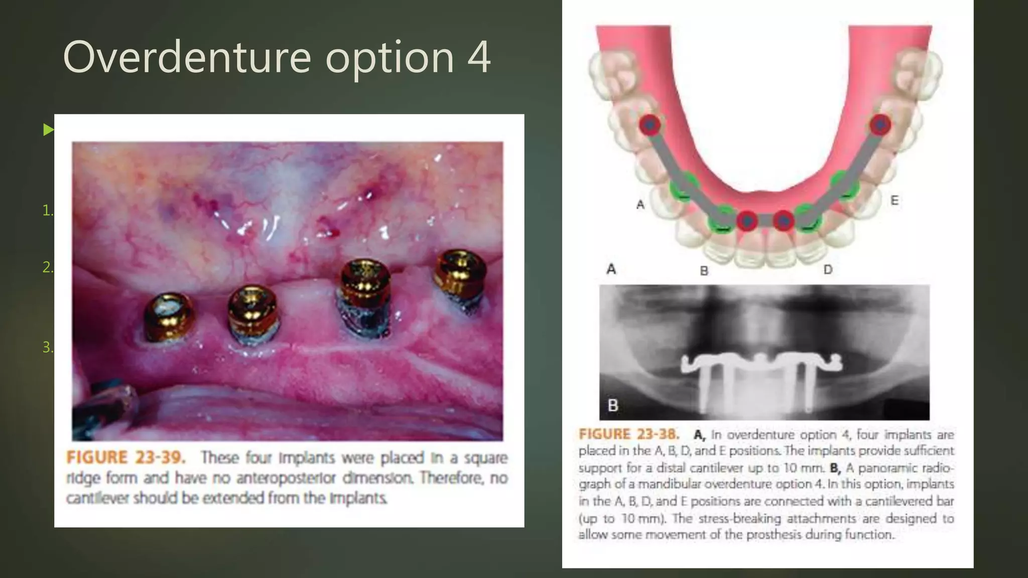 Prosthetic options in implant dentistry | PPTX