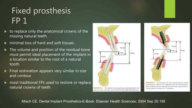 Prosthetic options in implant dentistry | PPTX