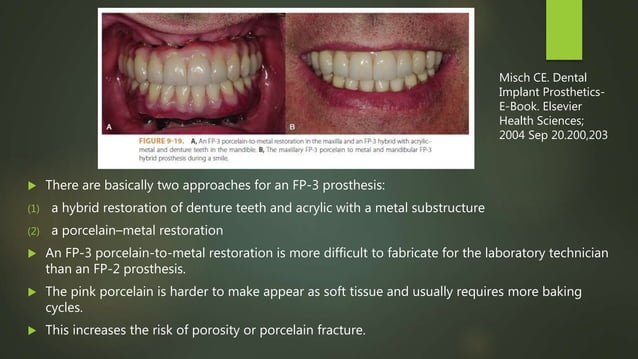 Prosthetic options in implant dentistry | PPTX