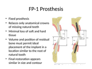 Prosthetic planning of dental implants.pptx
