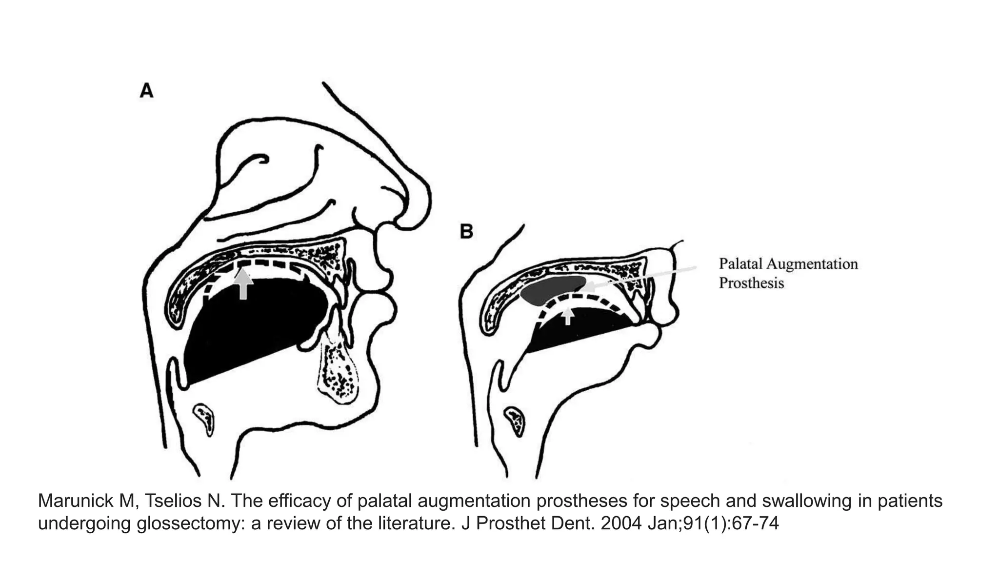Prosthetic rehabilitation of patient with partial and total.pptx