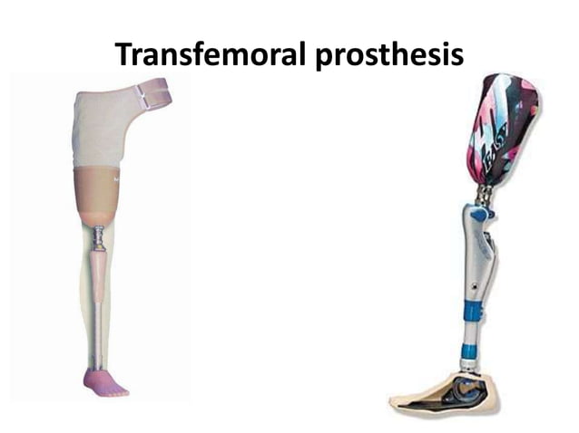 Prosthetics | PPTX
