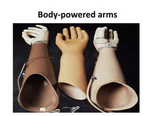 Prosthetics | PPTX