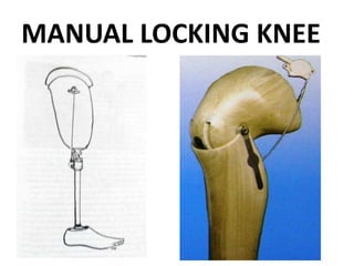 PROSTHETICS KNEE JOINTS.ppt | Physical Therapy | Wellness