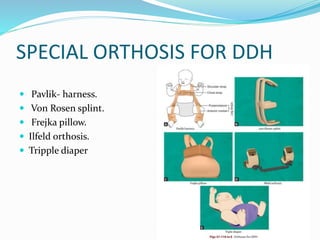 Prosthetics, orthotics and traction | PPTX