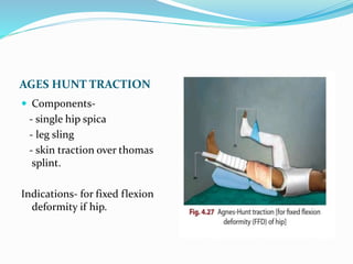 Prosthetics, orthotics and traction | PPTX