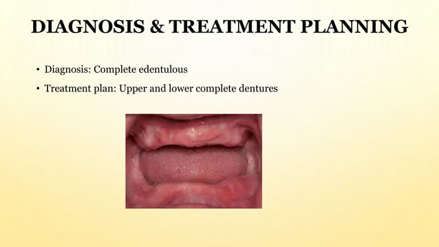 clinical & laboratory step in complete denture | PPTX