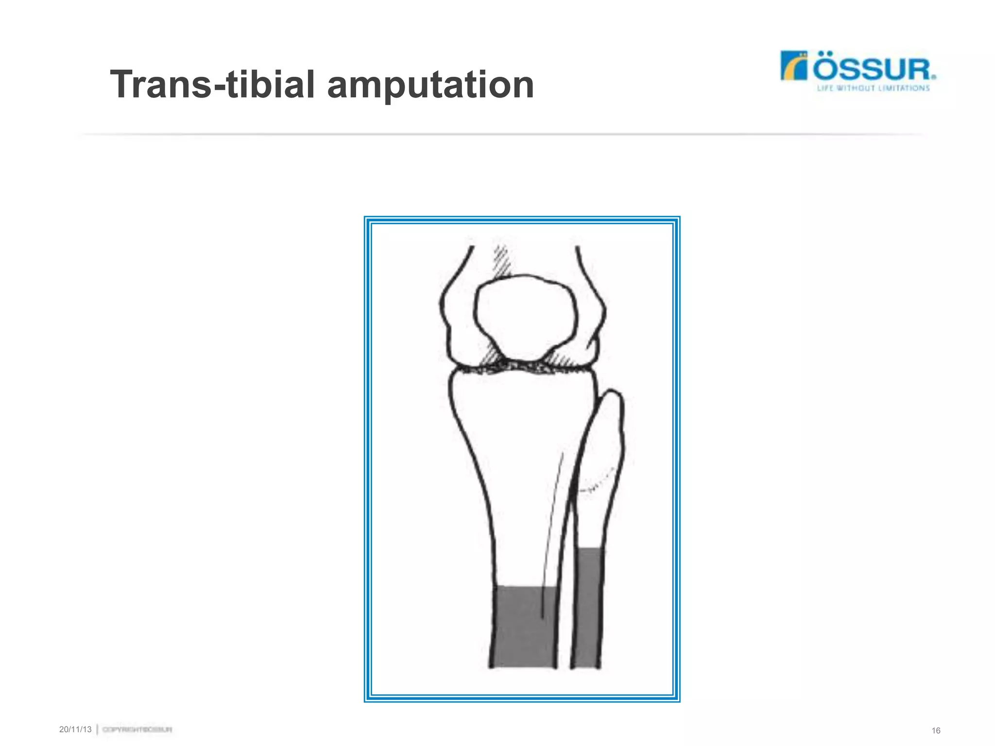 Basic Prosthetics II | PPTX