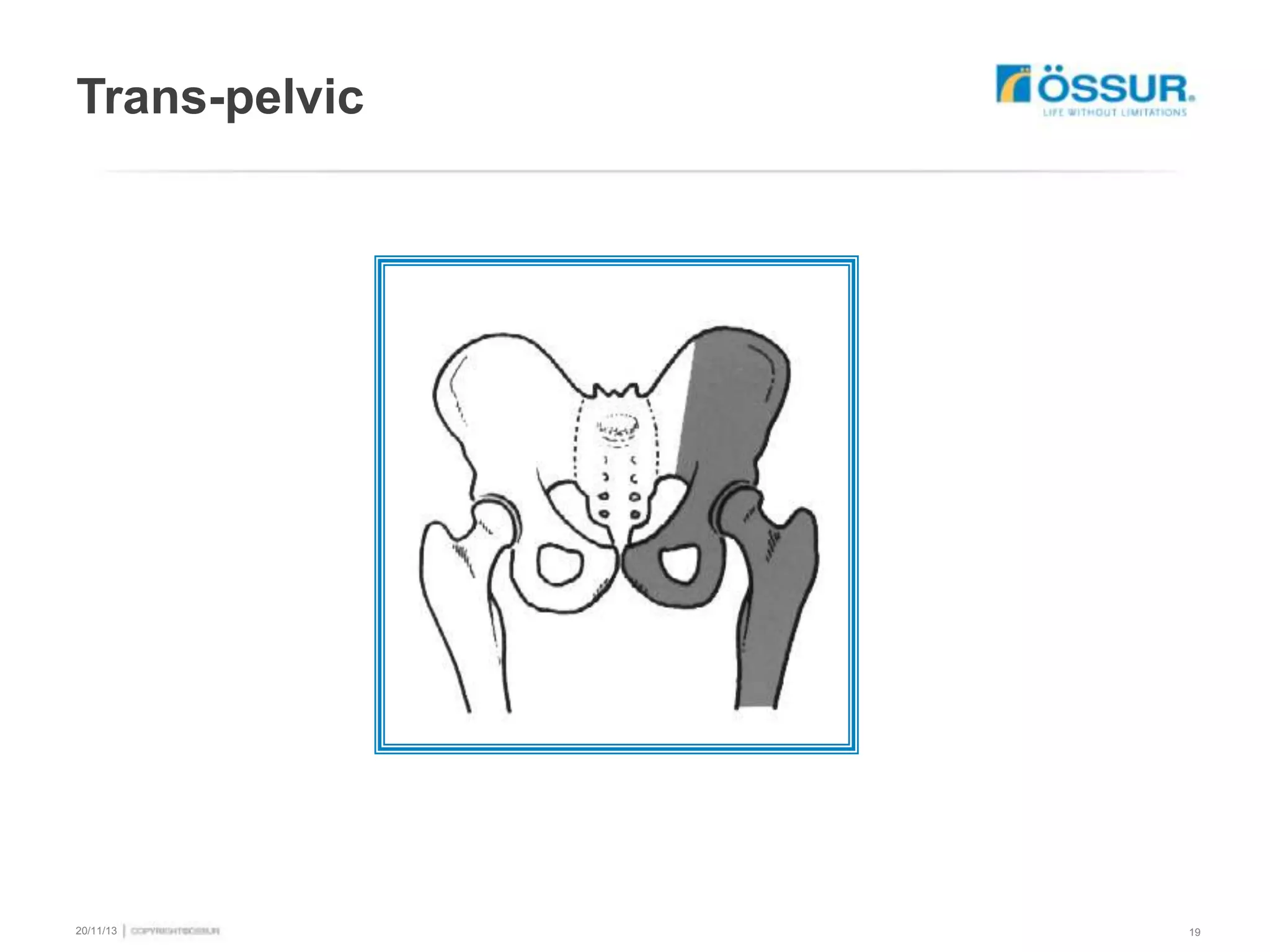 Basic Prosthetics II | PPTX