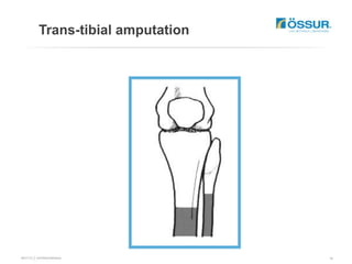 Basic Prosthetics II | PPTX