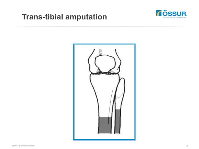 Basic Prosthetics II | PPTX | Death, Injury, or Military Conflict ...