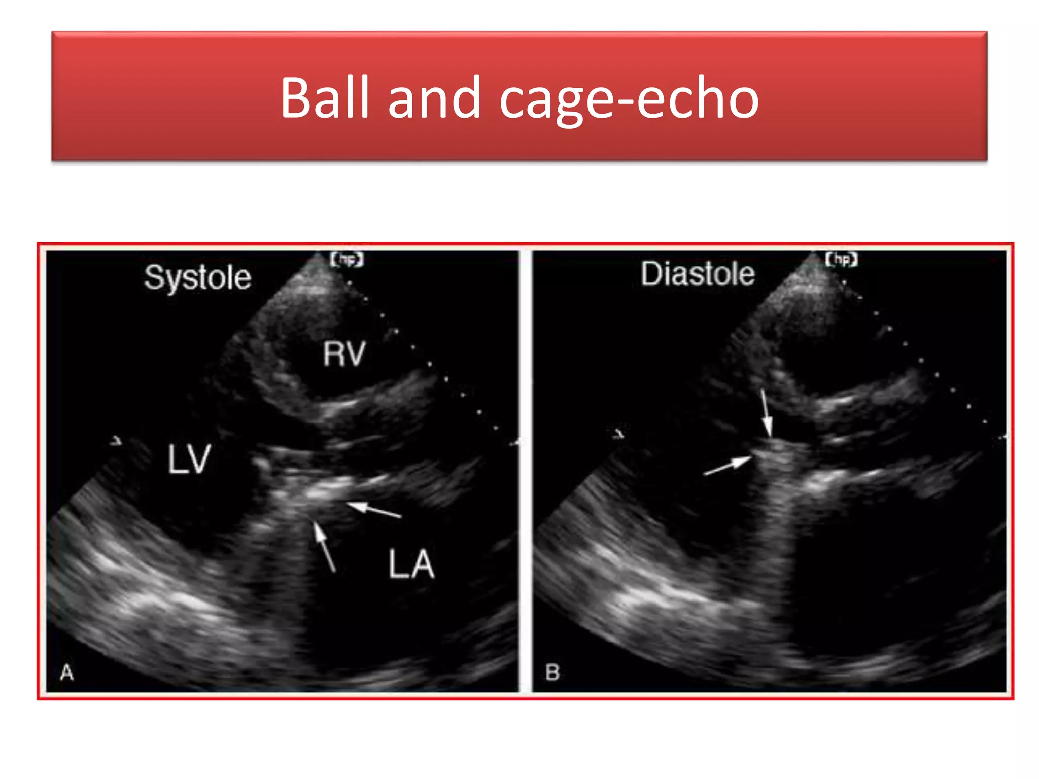 PROSTHETIC_VALVE_ECHO_ASSESSMENT_DR_SANTHOSH_CALICUTcardioSRcom.pptx