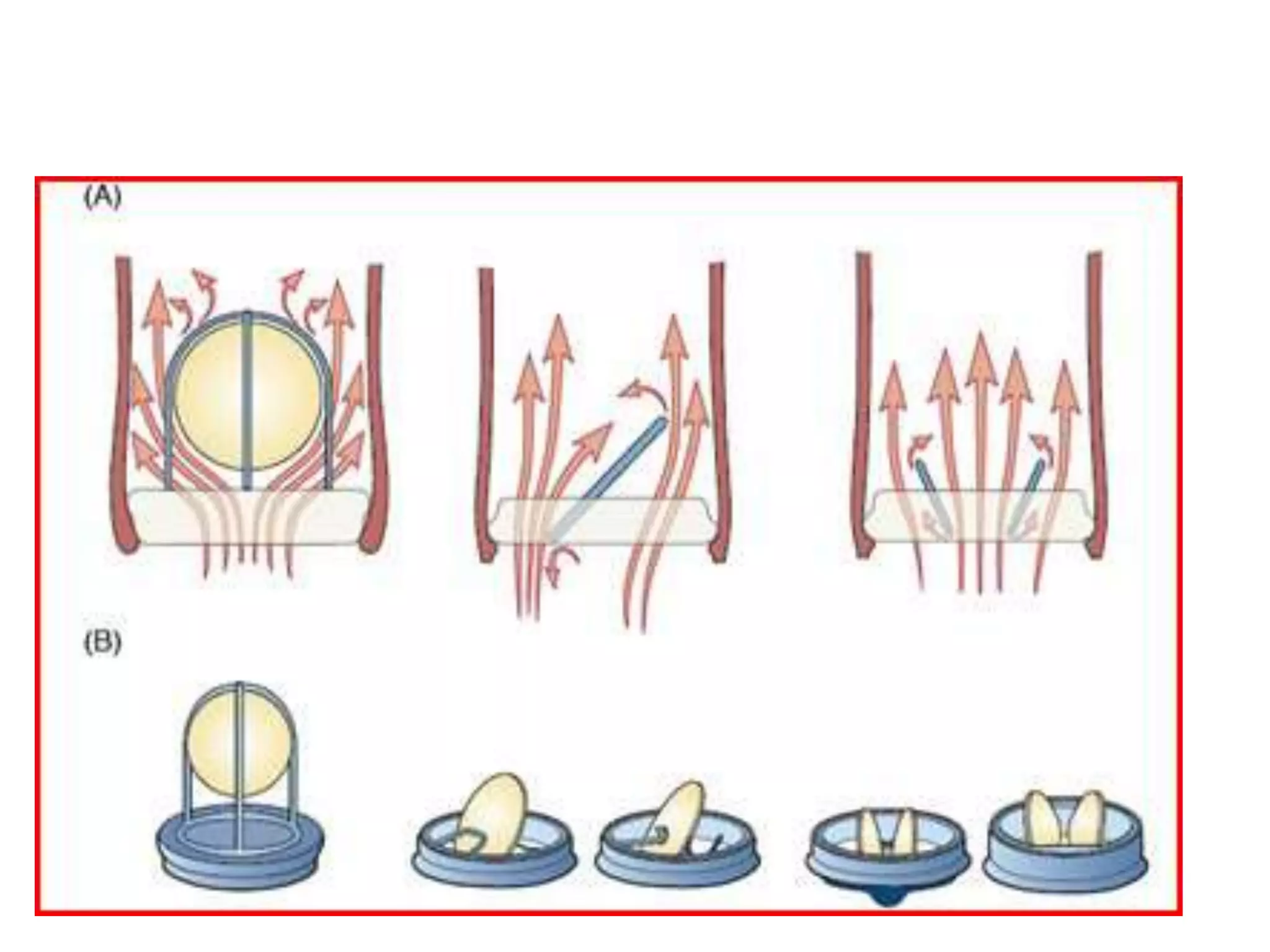 PROSTHETIC_VALVE_ECHO_ASSESSMENT_DR_SANTHOSH_CALICUTcardioSRcom.pptx