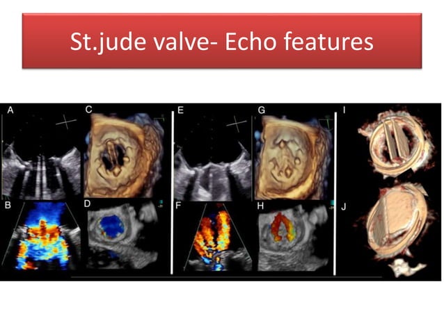 PROSTHETIC_VALVE_ECHO_ASSESSMENT_DR_SANTHOSH_CALICUTcardioSRcom.pptx ...